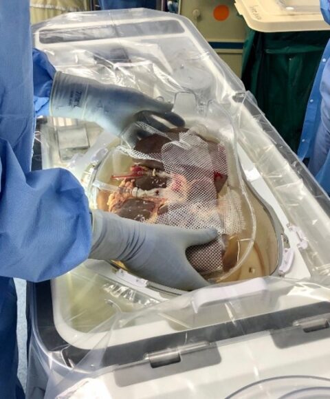 LifePort Liver Transporter by Organ Recovery Systems Achieves 100 ...